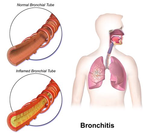 Difference Between Bronchitis And Acute Bronchitis Difference Between Bronchitis Vs Acute