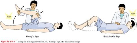 Brudzinski Sign Meningitis