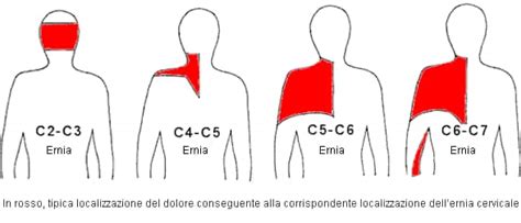 Ernia Cervicale Kinesportcenter