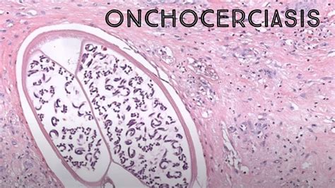 Onchocerca Volvulus Morphology