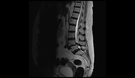 Lumbar Spondylolisthesis Mri Mri Of L5 Spondylolysis Stock Image