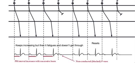 Ekg Disorders Of Av And Iv Conduction Flashcards Quizlet