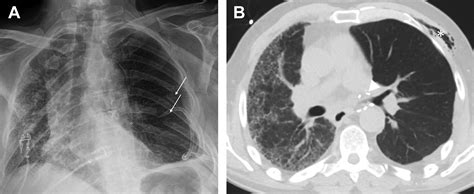 Imaging In Lung Transplantation Radiologic Clinics