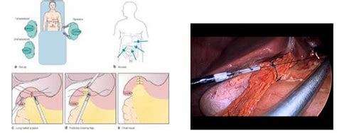 Best Laparoscopic Appendectomy In Thane West Call 8484930905