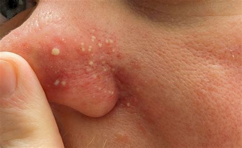 [acne] Recurring White Pimples Pustules On One Side Of My Nose R Skincareaddiction