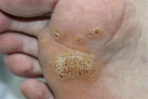 Verrucae And Warts Lindsey Ebbs Podiatry