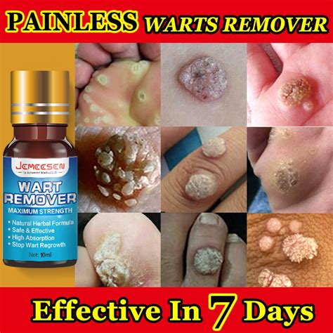 【jemeesen】 Wart Remover Skin Tag Remover Wart Treatment Painless Mole