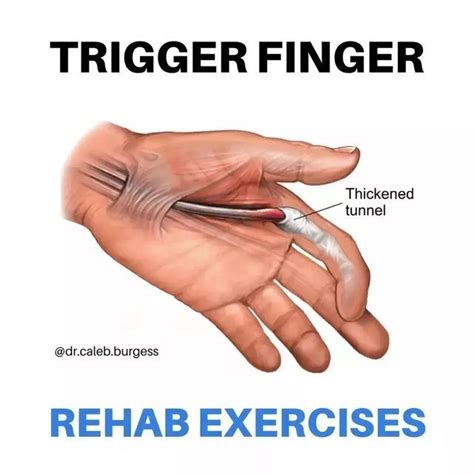 Stretching | Mobility on Instagram: "💥Trigger Finger💥 Follow @stretchingguru 👈 🎯 "Trigger ...