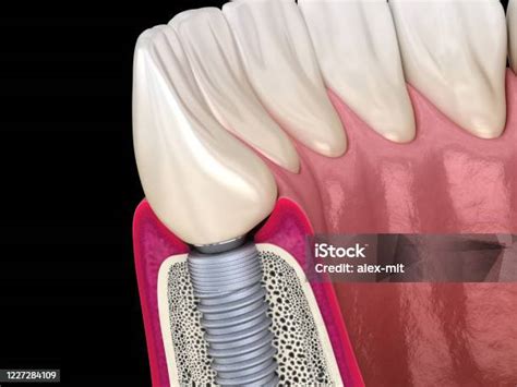 표준 어버트먼트 치과 용 임플란트 및 세라믹 크라운 의학적으로 정확한 치아 3d 그림 건강관리와 의술에 대한 스톡 사진 및 기타 이미지 건강관리와 의술 단면도 도예