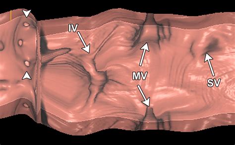 Three Dimensional Virtual Dissection At Ct Colonography Unraveling The