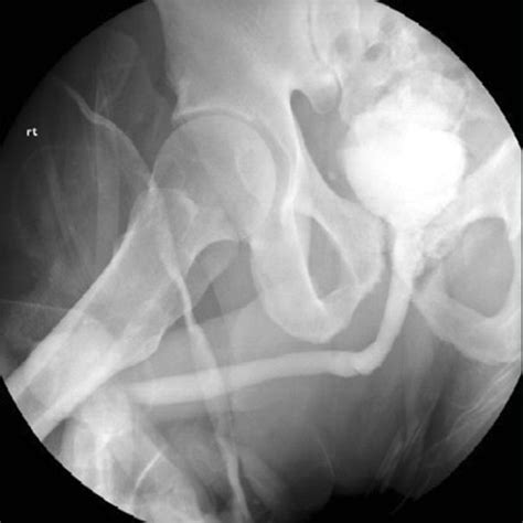 Postoperative Voiding Cystourethrogram Demonstrating Excellent Patency