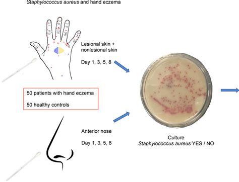 Colonization With Staphylococcus Aureus In Patients With Hand Eczema Prevalence And Association
