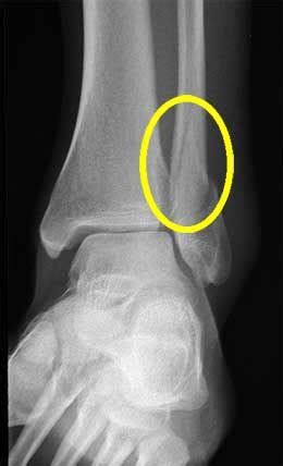 Broken Ankle Symptoms Causes And Treatment Options