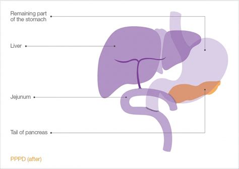 Treatment Options For Pancreatic Cancer Pancreatic Cancer Action
