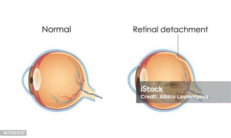 Retinal Detachment Eye Disease Flat Vector Illustration Medicine Stock