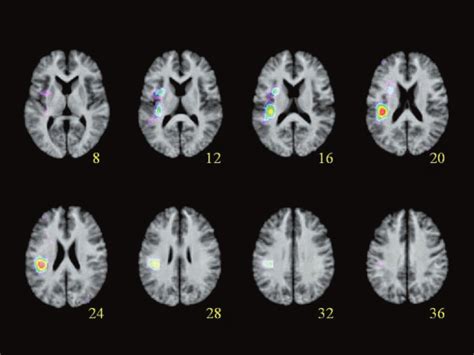Statistical Parametric Map Of Response Difference Thresholded By P Download Scientific Diagram