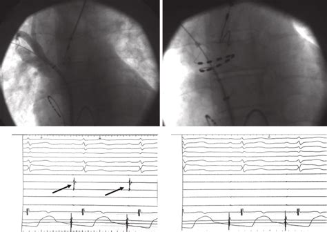 A Case Of Pulmonary Vein Pv Isolation Is Displayed With Use Of The Download Scientific