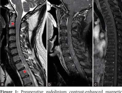 Figure From Spinal Cord Diffuse Midline Glioma With Postoperative Acute Swelling A Case