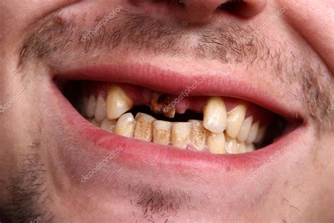 V Nasty Teeth