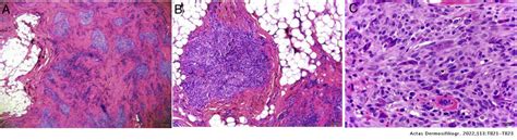 Translated Article Plexiform Fibrohistiocytic Tumor In A 12 Year Old
