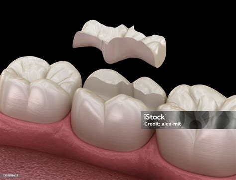 치아 위에 세라믹 크라운 고정을 상감 인간의 치아 치료의 의학적으로 정확한 3d 그림 상감 세공에 대한 스톡 사진 및 기타 이미지 상감 세공 이빨 3차원 형태