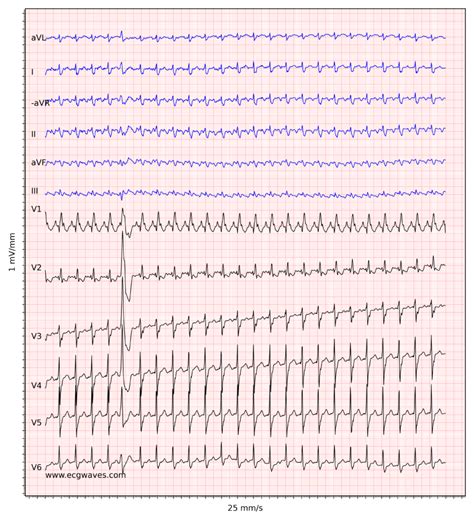 Atrial Flutter Classification Causes Ecg Criteria And Management