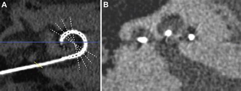 Ultra High Resolution Ct To Detect Intracochlear New Bone Formation After Cochlear Implantation