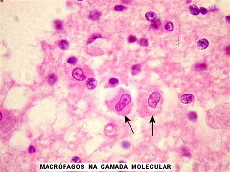 Fichero De Hematologia Macrofago O Histiocito