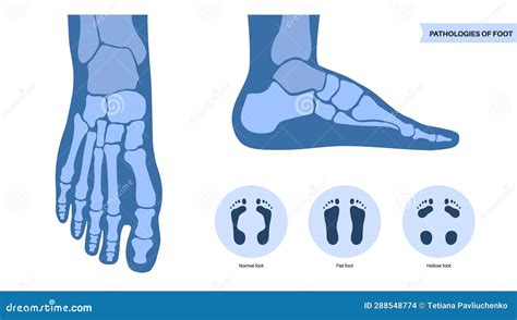 Foot Pathologies Poster Stock Vector Illustration Of Pathology 288548774