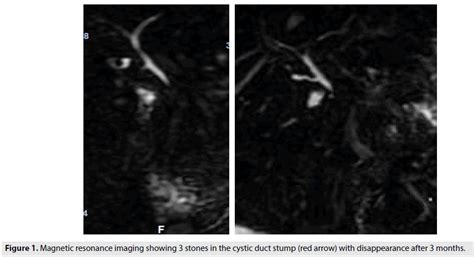 Residual Cystic Stump Stones Following Cholecystectomie