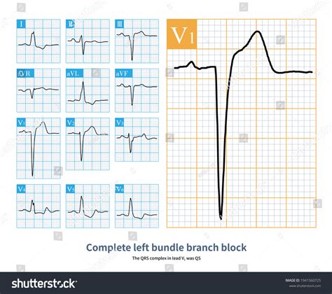Complete Left Bundle Branch Block Qrs Stock Illustration 1941560725 Shutterstock