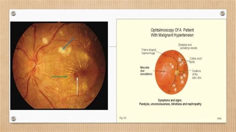 Hypertensive Retinopathy Ppt