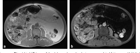 Figure 2 From Ct And Mr Imaging Features Of Diffuse Lipomatosis Of The