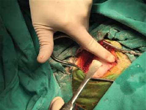 Craniectomy Site After Dura Was Sutured Figure 2 Semiliquid Pmma Is