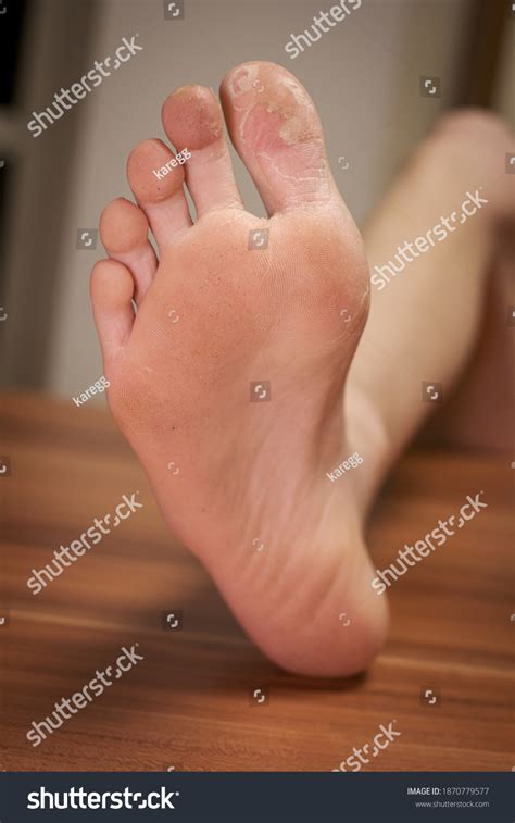 On One Big Toe Skin Detaches Stock Photo Edit Now