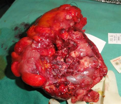 A Modified Posterior Pelvic Exenteration Technique In A Woman A Simplified Method With Using