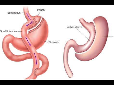 Roux En Y Gastric Bypass Afferent Limb