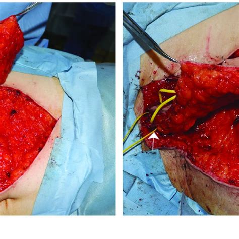 The Scip Flap Was Elevated Saving The Deep Fat A The Deep Fat