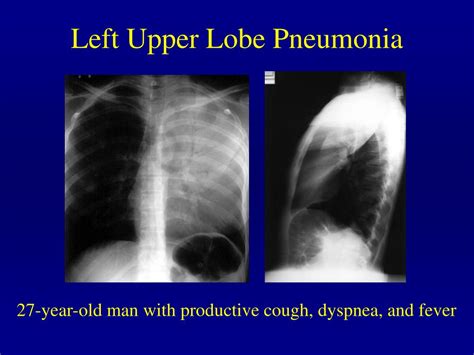 Ppt Chest Radiographs Powerpoint Presentation Free Download Id 295432