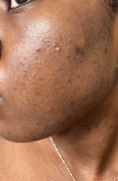Acne Help Small Bumps Rskincareaddiction