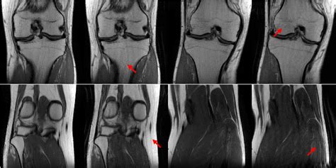Score Based Generative Priors Guided Model Driven Network For Mri