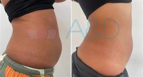 Tratamiento Con Endolift® Endoláser Rejuvenecimiento Facial Y Corporal
