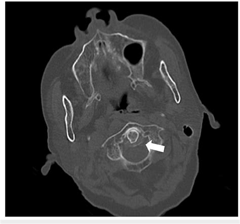 Figure 2 From Comorbidity Between Crowned Dens Syndrome And Primary