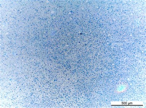 Pathology Outlines Case Of The Month 546