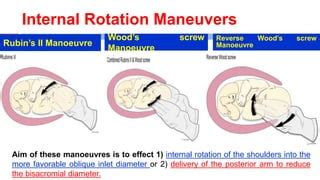 Shoulder Dystocia Woods Screw Maneuver