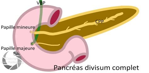 Fiche Maladie Pancréas Divisum