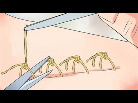 How To Remove Suture Part YouTube