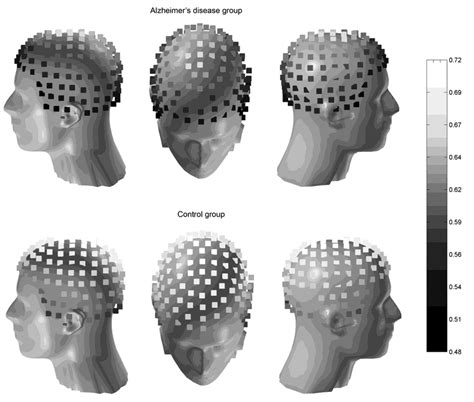 Average LZC Values From MEGs In AD Patients And Control Subjects For Download Scientific