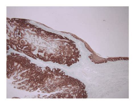 Immunohistochemical Staining Reveals Strong Positivity For P16ink4a ×