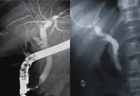 Laparoscopic Cholecystectomy Common Bile Duct Exploration And Liver